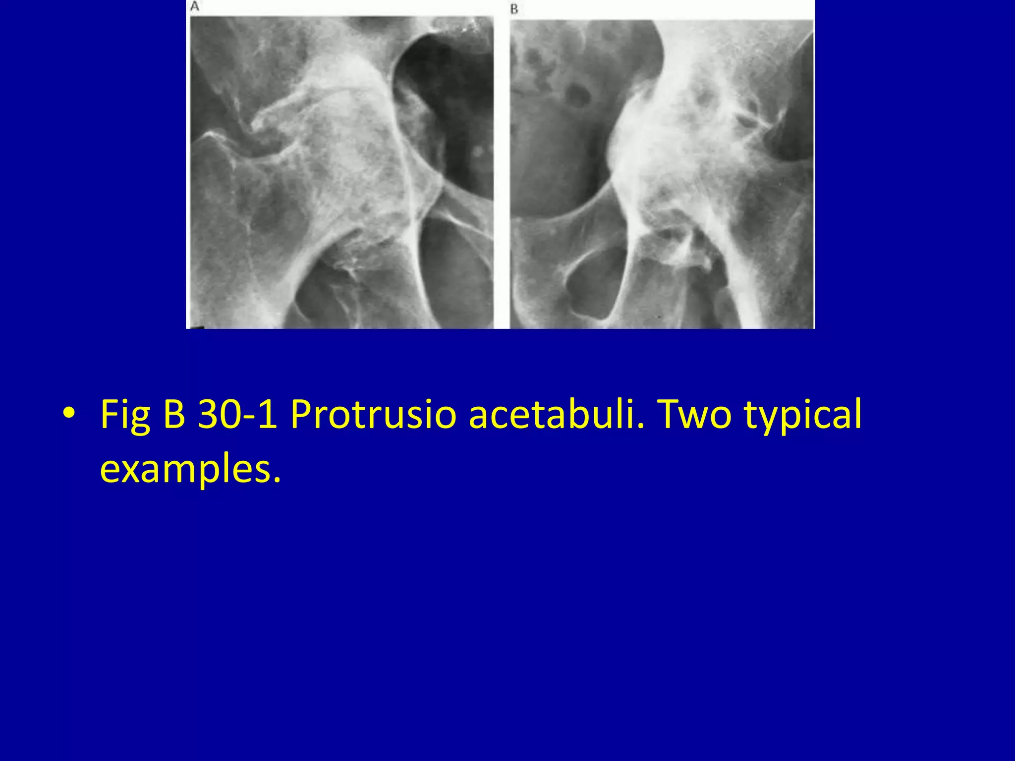 30 protrusio acetabuli | PPTX