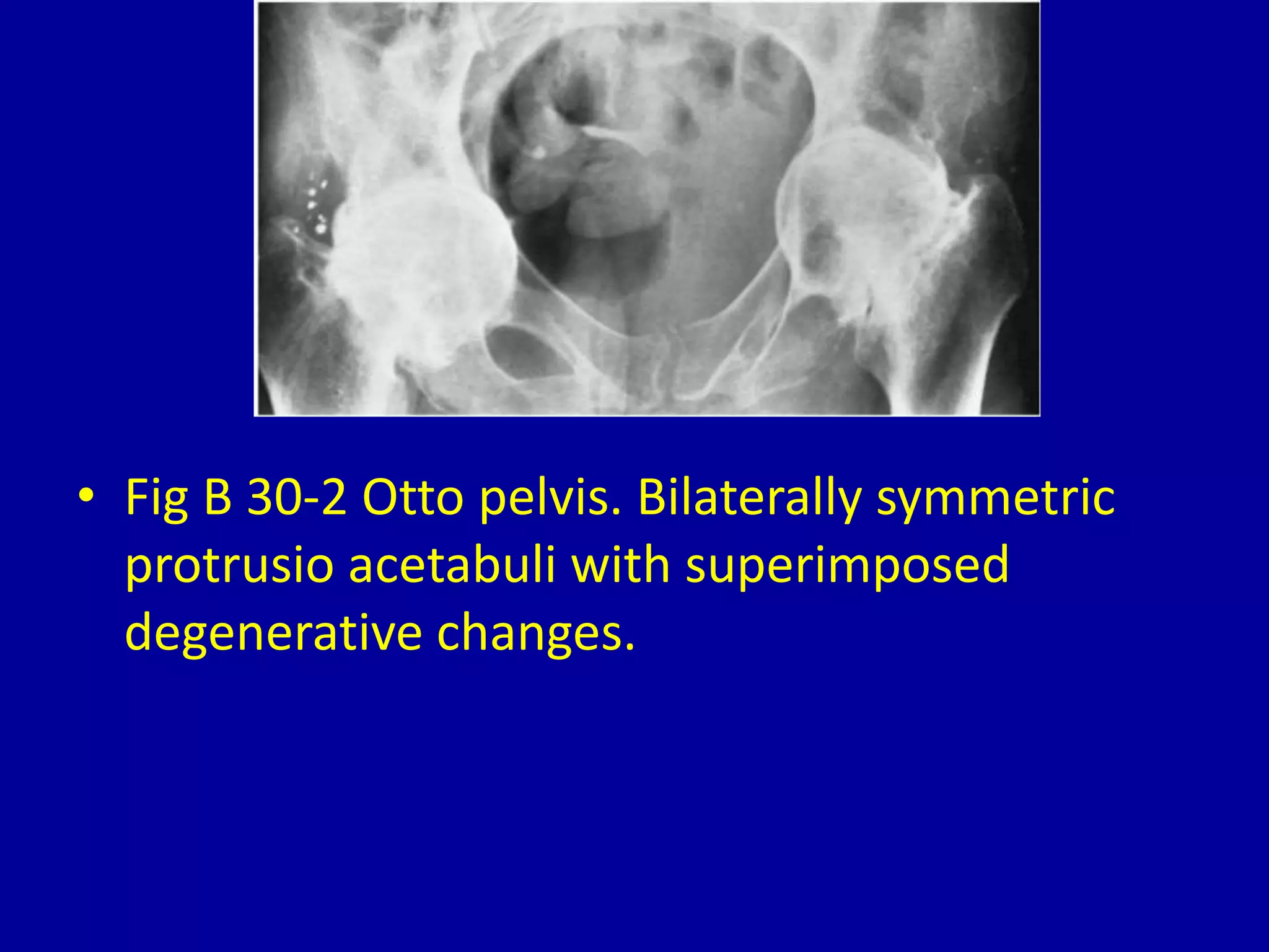 30 protrusio acetabuli | PPTX