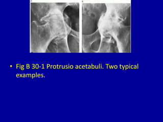 30 protrusio acetabuli | PPTX