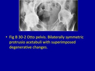 30 protrusio acetabuli | PPTX