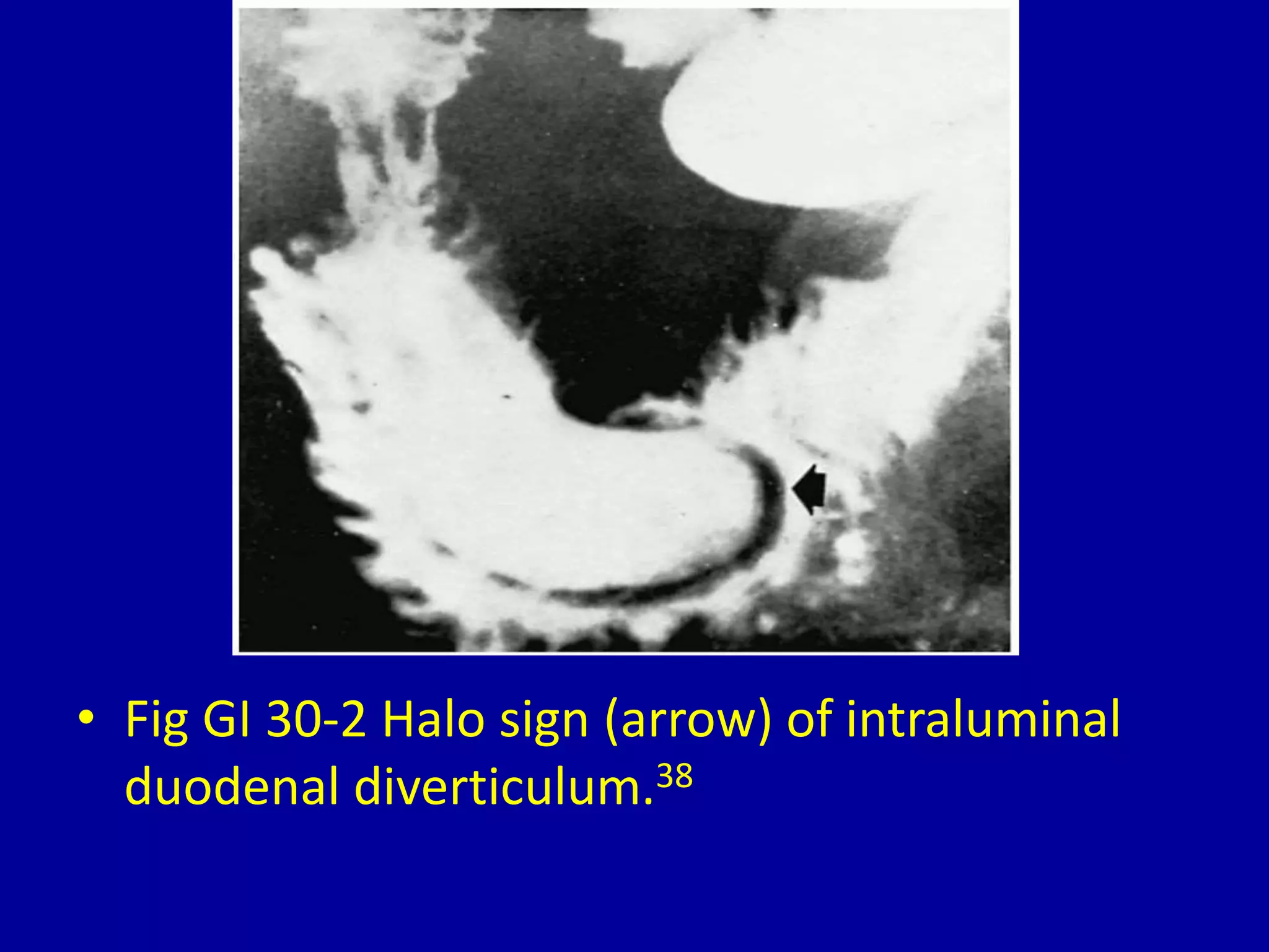 30 small bowel diverticula and pseudodiverticula | PPTX | Digestive ...