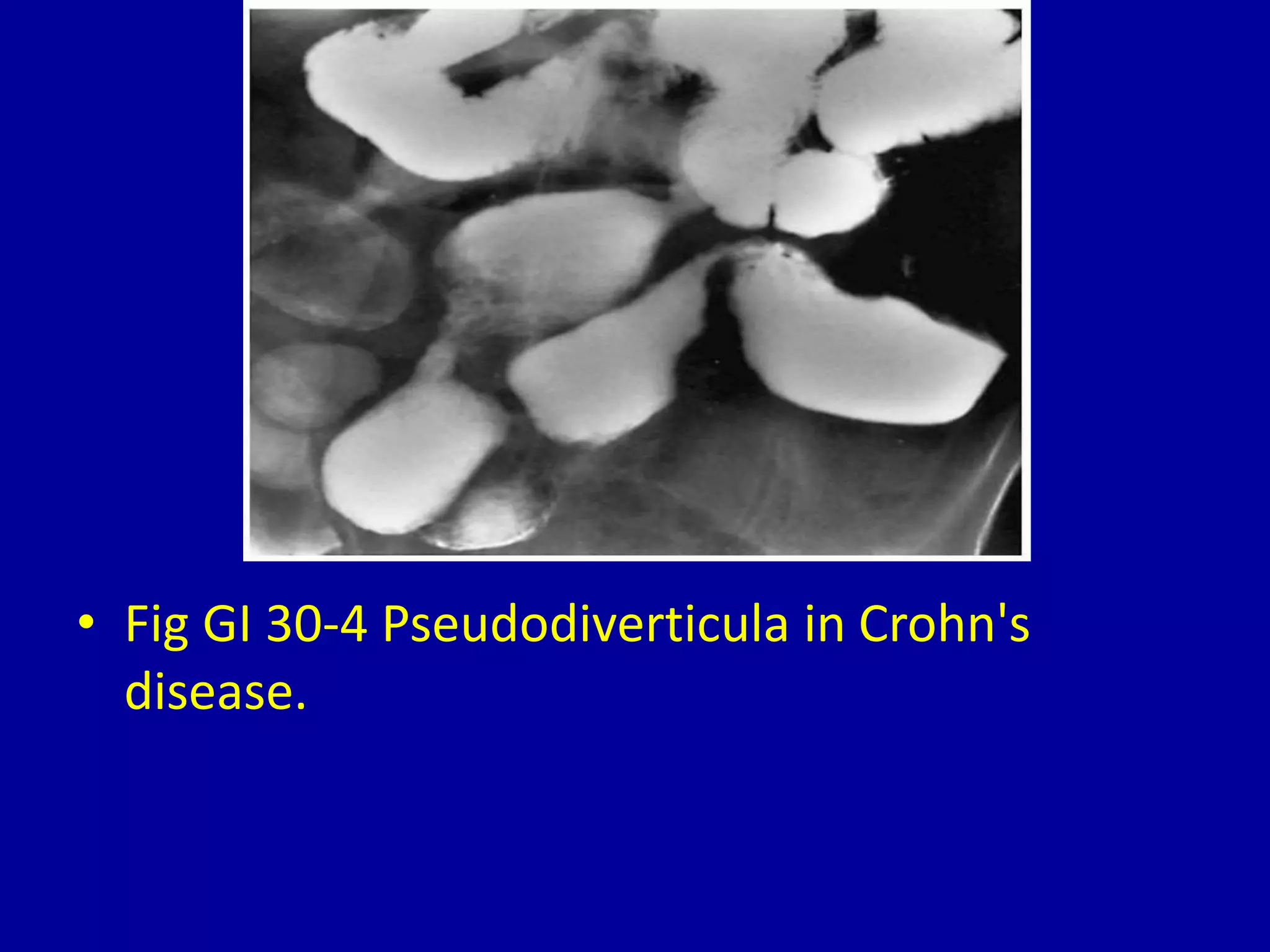 30 small bowel diverticula and pseudodiverticula | PPTX | Digestive ...