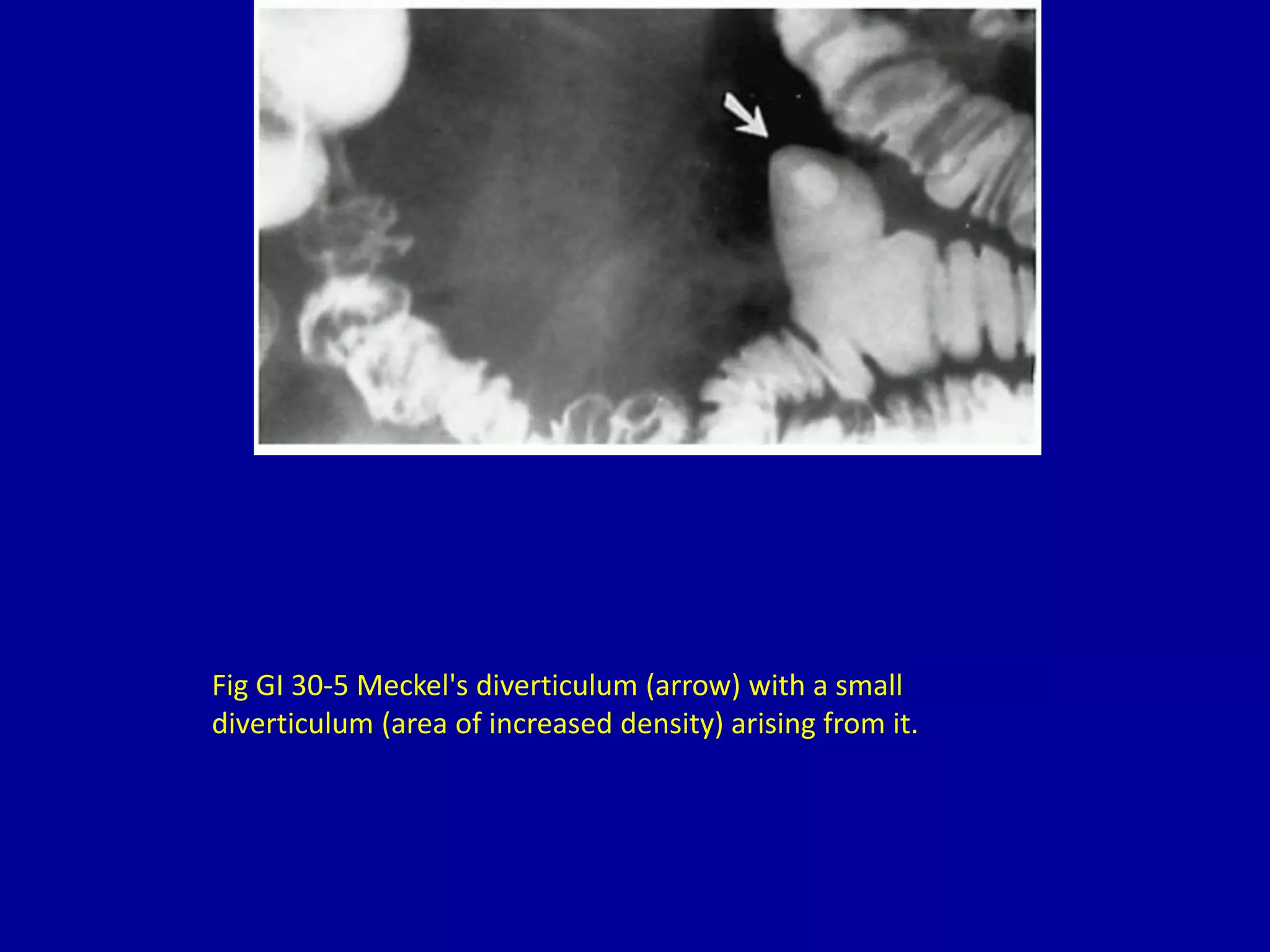 30 small bowel diverticula and pseudodiverticula | PPTX | Digestive ...