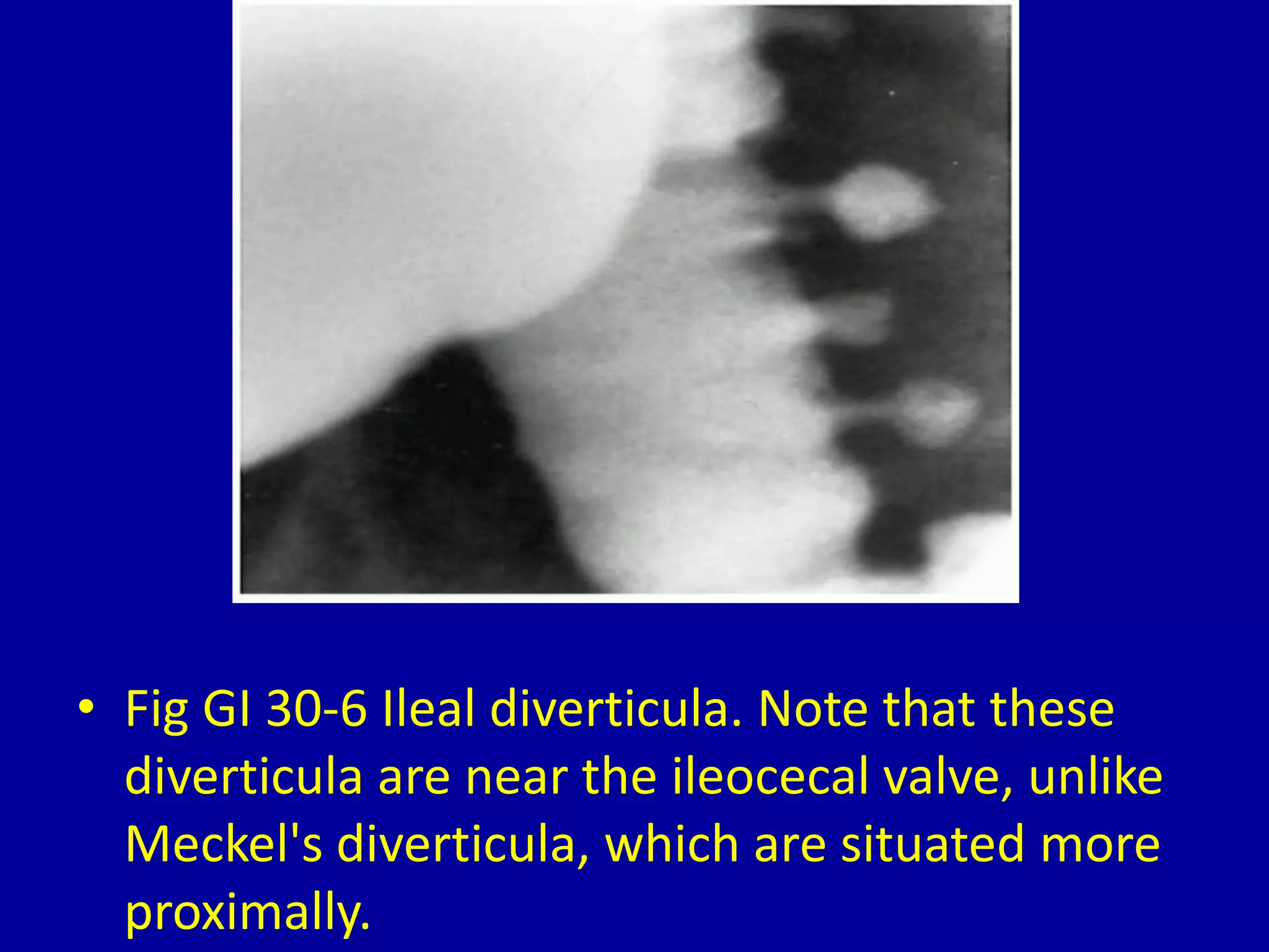 30 small bowel diverticula and pseudodiverticula | PPTX | Digestive ...
