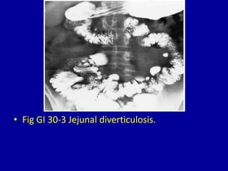 30 small bowel diverticula and pseudodiverticula | PPTX