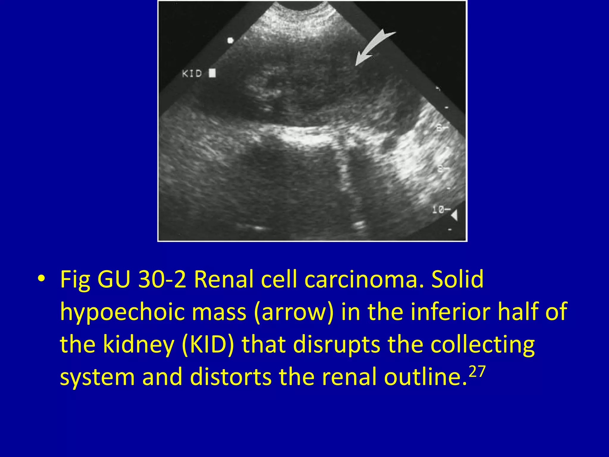 30 solid renal masses | PPTX