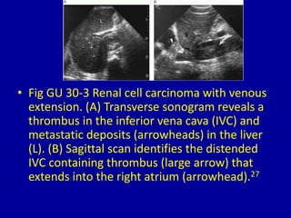 30 solid renal masses | PPTX