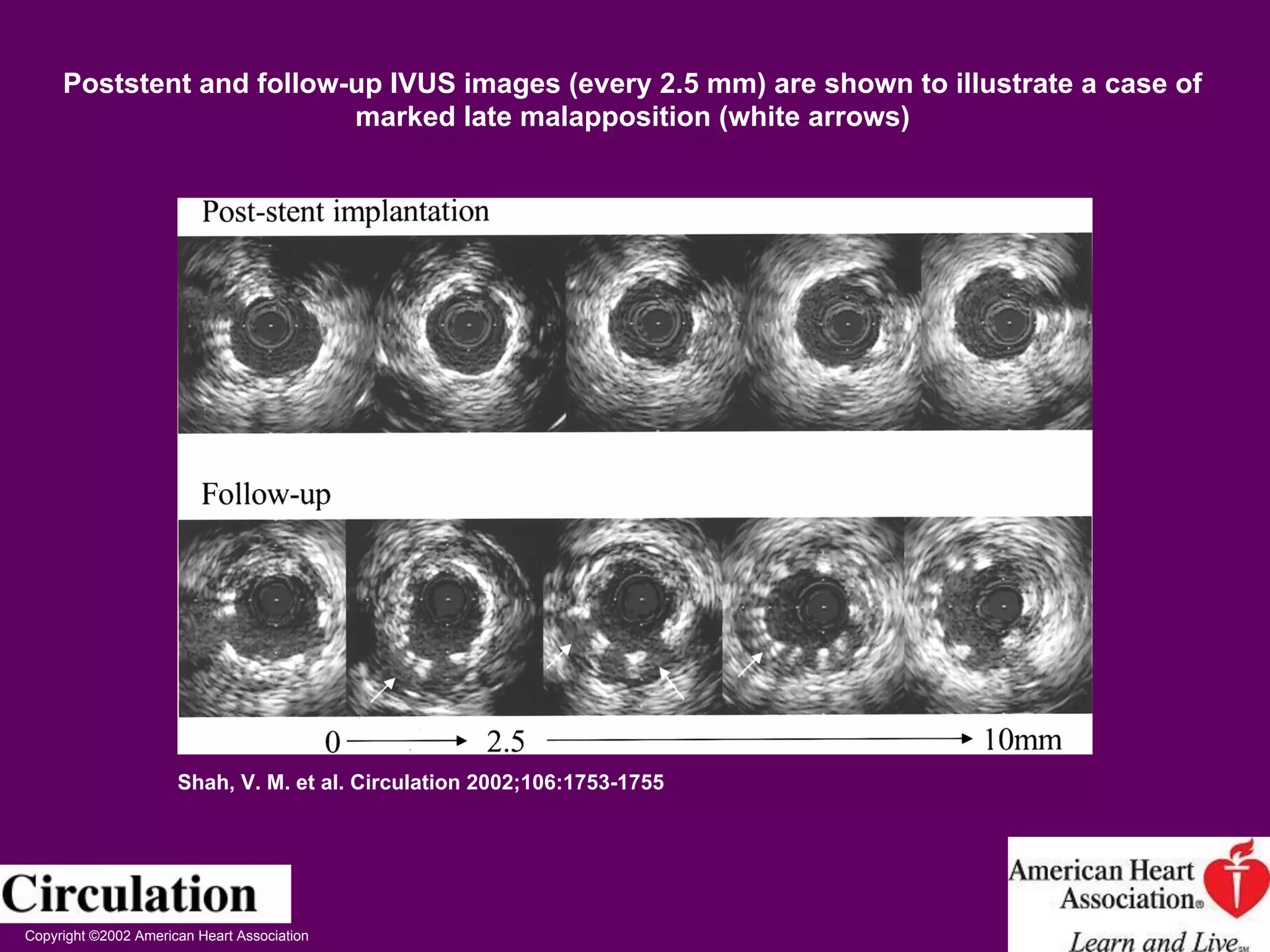 30 years of percutaneous coronary intervention.pptx