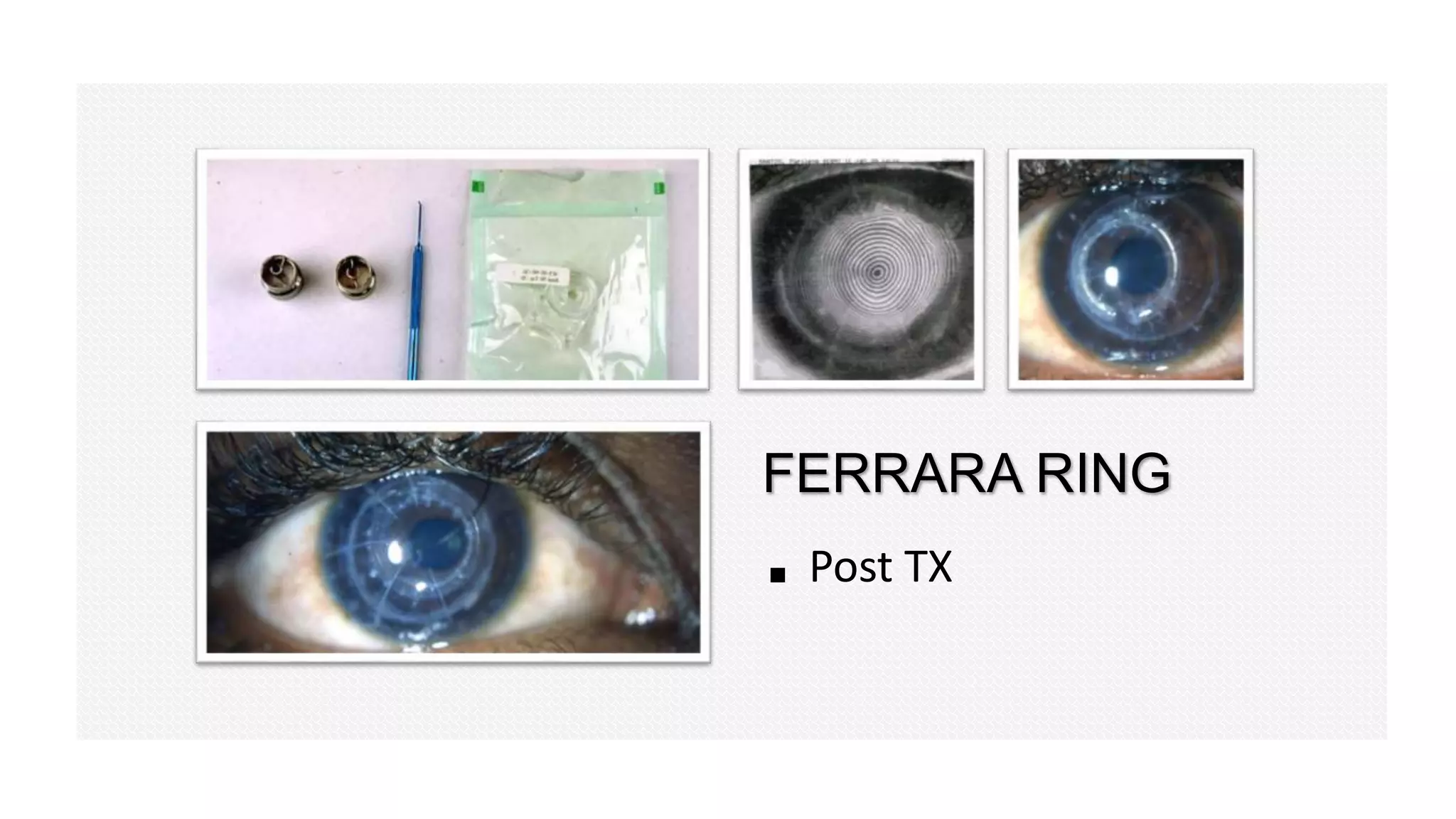 Ferrara Ring - 30yo - 1998 - ceratocone | PPTX | Eye and Vision ...