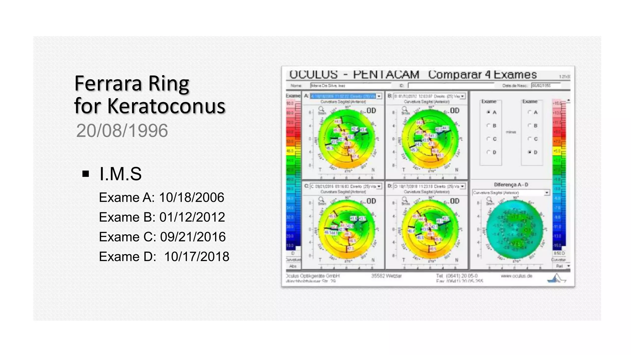 Ferrara Ring - 30yo - 1998 - ceratocone | PPTX | Eye and Vision ...