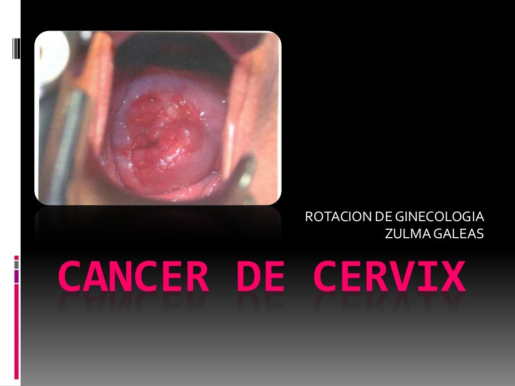 Cáncer De Cérvix: ¿Qué Es? – Cáncer Cervicouterino Fotos – RCAD