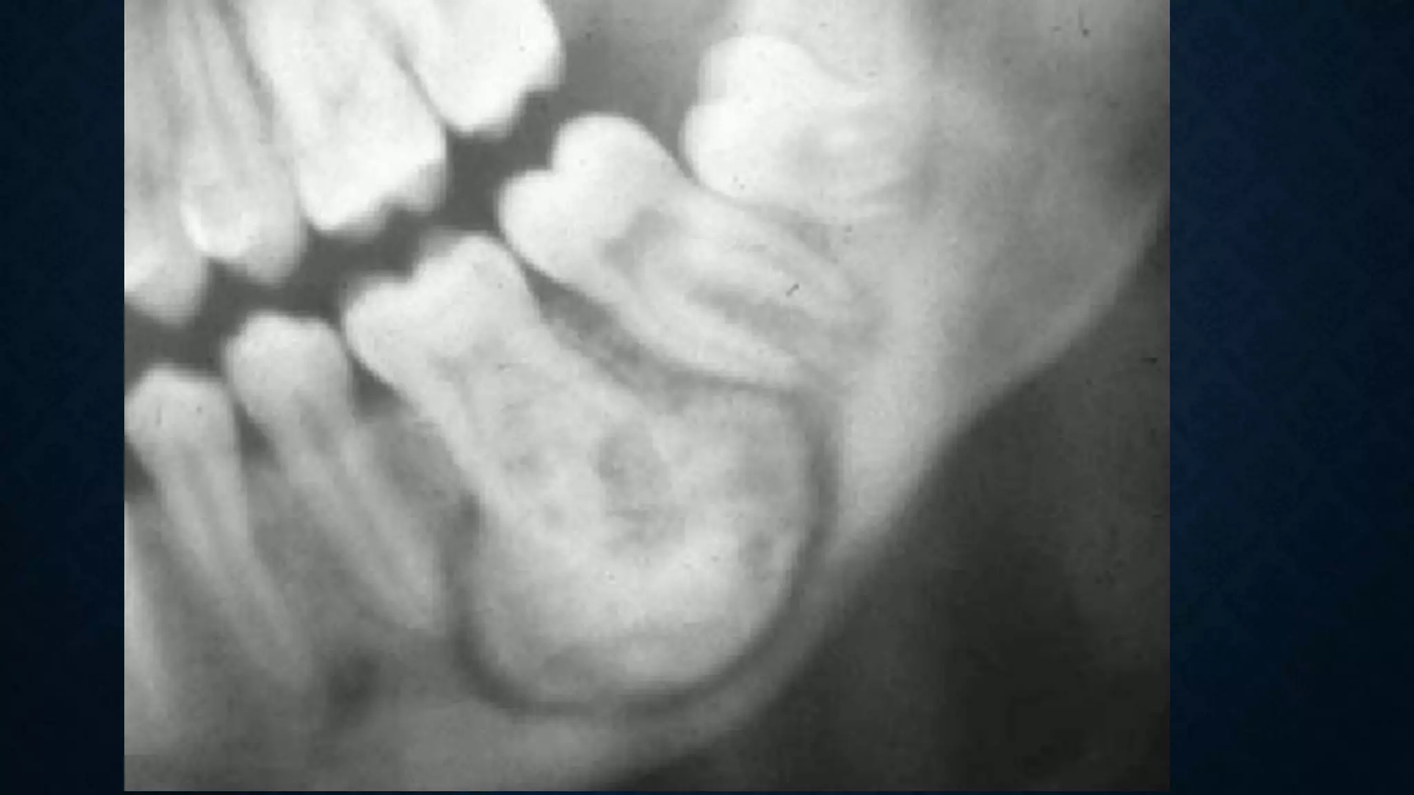 Benign Odontogenic Tumors of the Jaws | PPTX
