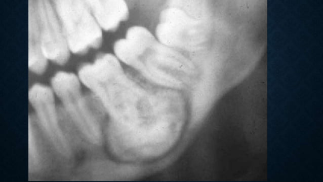 Benign Odontogenic Tumors of the Jaws | PPT