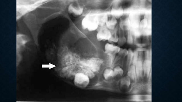 Benign Odontogenic Tumors of the Jaws | PPT