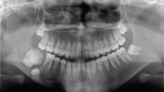Benign Odontogenic Tumors of the Jaws | PPT