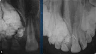 Benign Odontogenic Tumors of the Jaws | PPT