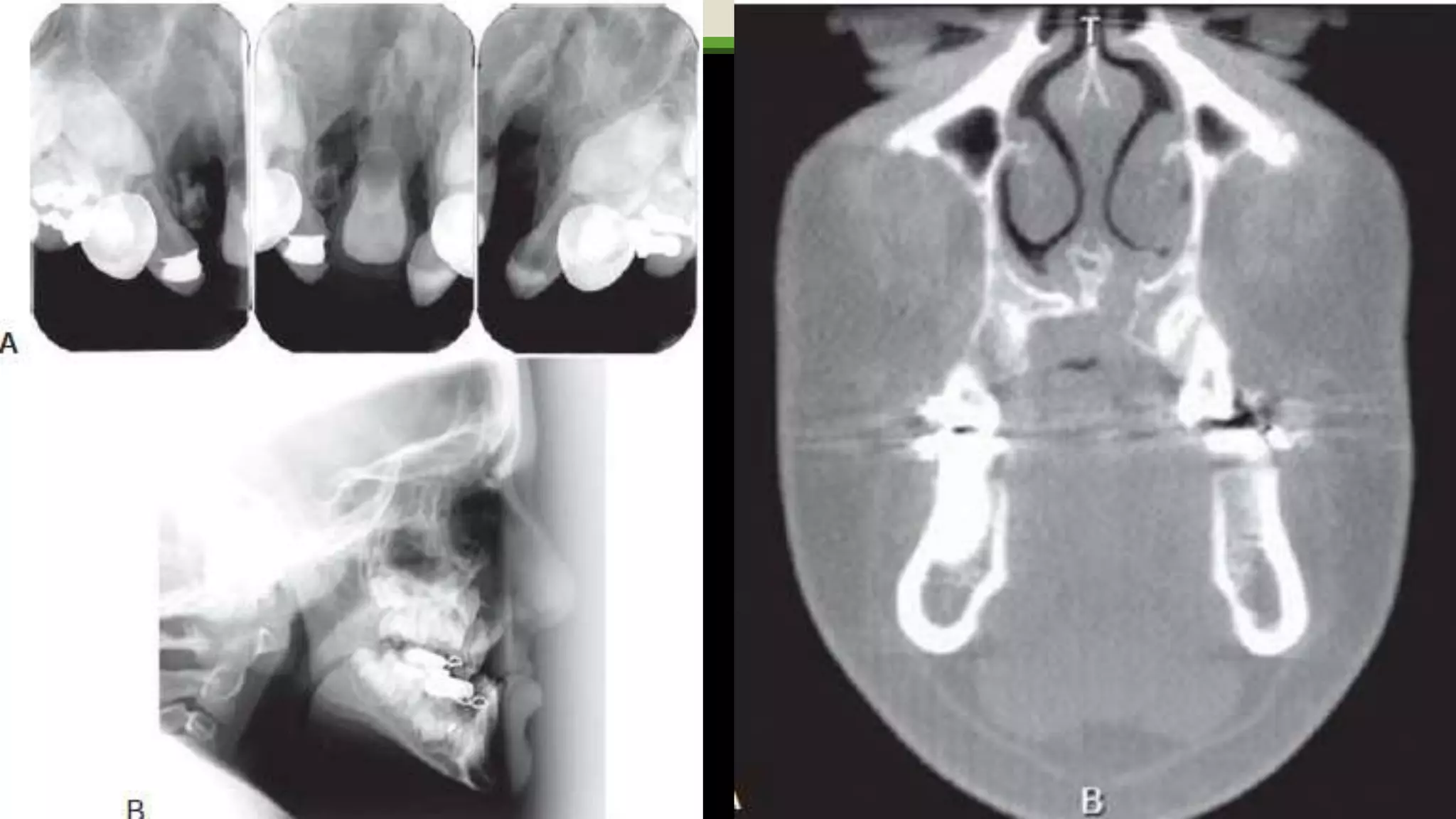 Radiographic Features of Developmental Anomalies in the Face and Jaws ...