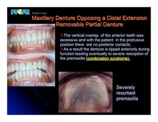 31.(new)single dentures opposing natural dentition (n) | PDF