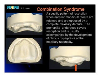 31.(new)single dentures opposing natural dentition (n) | PDF