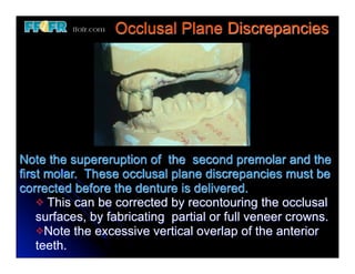 31.(new)single dentures opposing natural dentition (n) | PDF