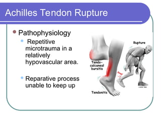ruptur Achilles-Tendon and management-ppt.ppt