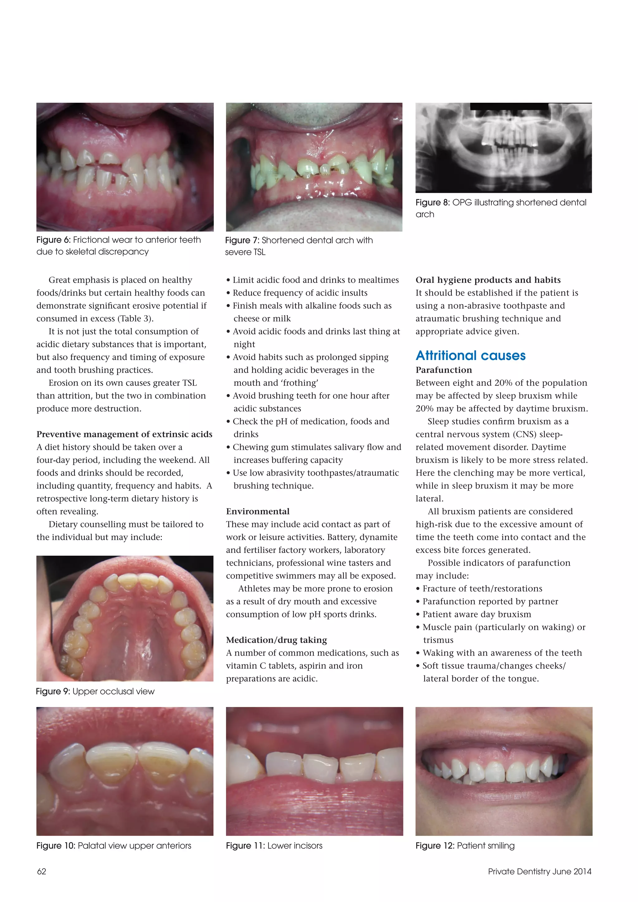 ToothSurfaceLoss_Part1 | PDF