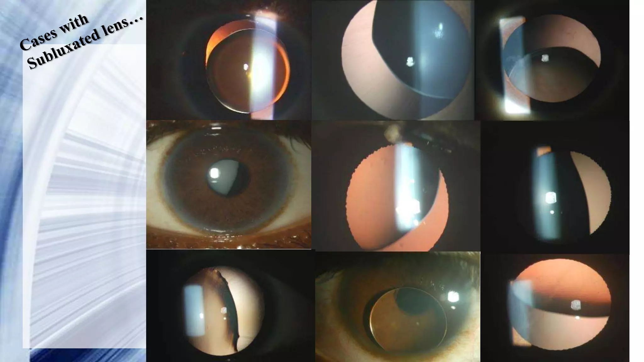 Save The Titanic Iris Fixated Iols In The Management Of Ectopia Lentis ...