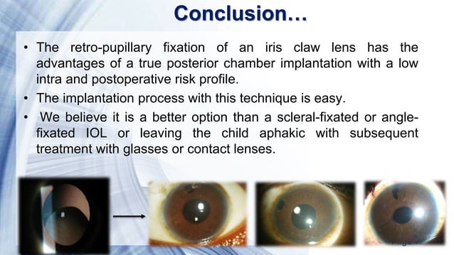 Save The Titanic Iris Fixated Iols In The Management Of Ectopia Lentis ...