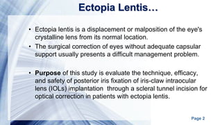 Save The Titanic Iris Fixated Iols In The Management Of Ectopia Lentis ...