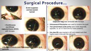 Save The Titanic Iris Fixated Iols In The Management Of Ectopia Lentis ...