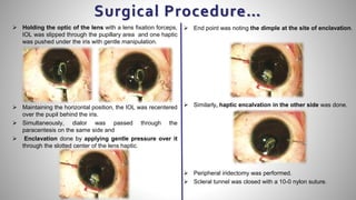 Save The Titanic Iris Fixated Iols In The Management Of Ectopia Lentis ...