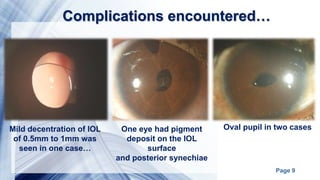 Save The Titanic Iris Fixated Iols In The Management Of Ectopia Lentis ...