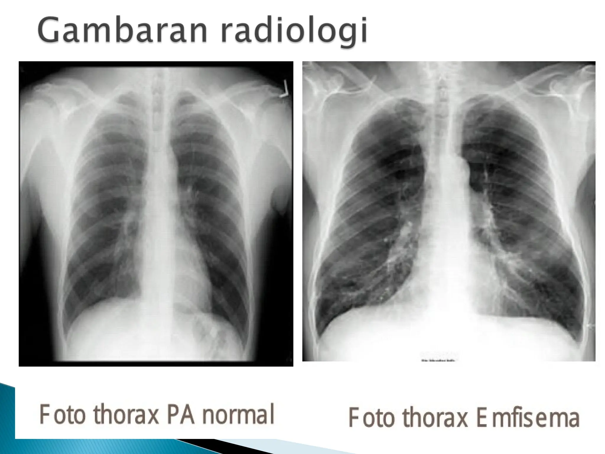 319865415-PPT-Emfisema-Paru-Radiologi.ppt