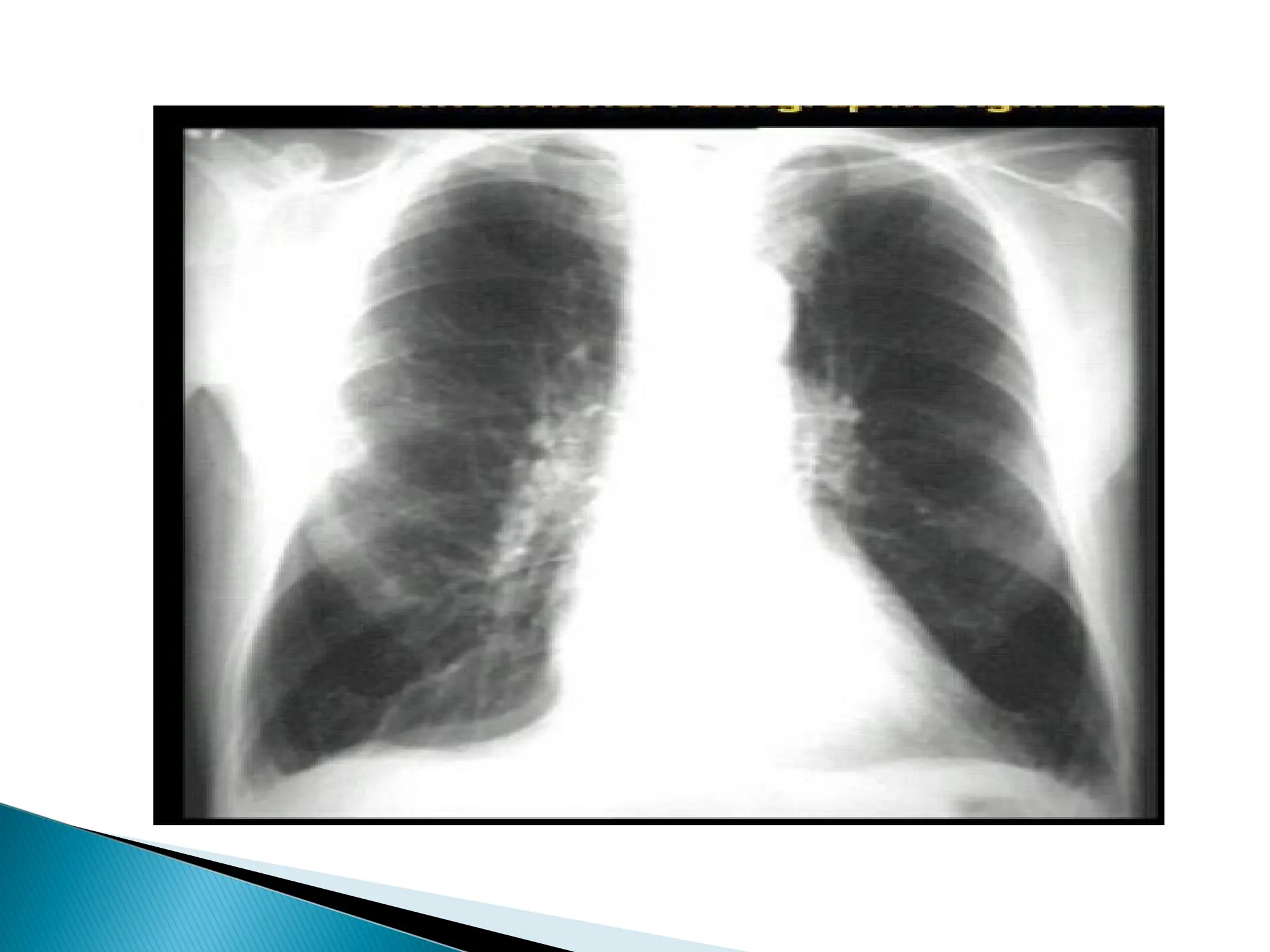 319865415-PPT-Emfisema-Paru-Radiologi.ppt