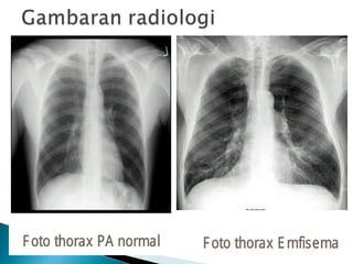 319865415-PPT-Emfisema-Paru-Radiologi.ppt