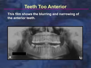 panoramic-techique errors | PPT