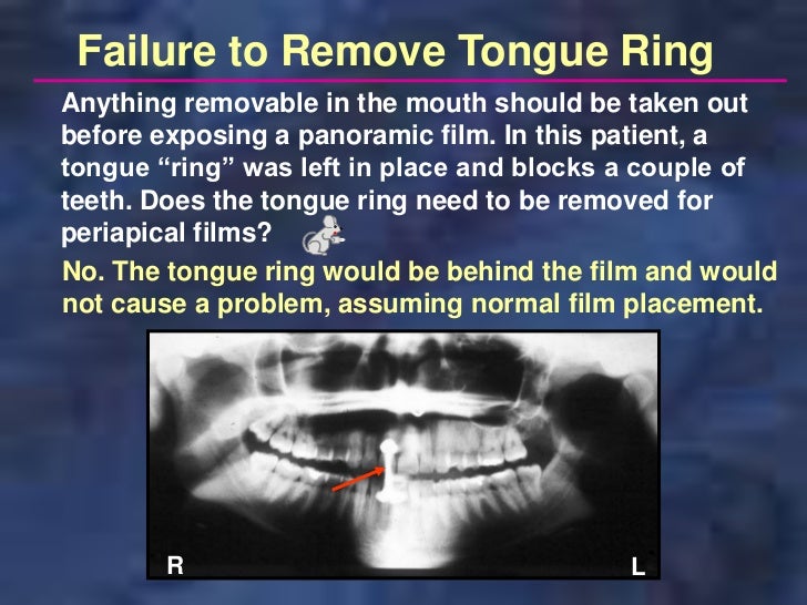 panoramic-techique errors