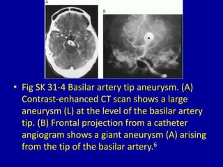 31 aneurysms and vascular malformations | PPTX