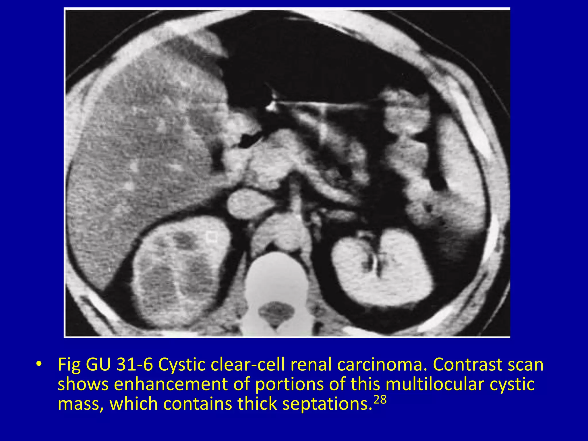 31 cystic renal masses on computed tomography | PPTX | Medical Health