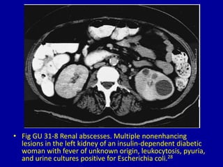31 cystic renal masses on computed tomography | PPTX