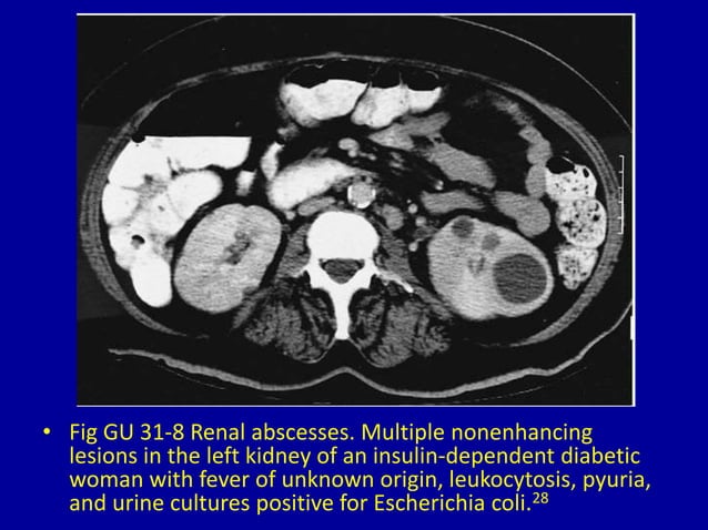 31 cystic renal masses on computed tomography | PPTX | Medical Health