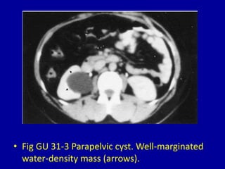 31 cystic renal masses on computed tomography | PPTX