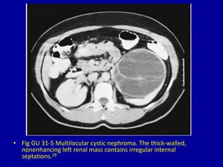 31 cystic renal masses on computed tomography | PPTX