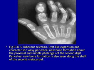 31 dactylitis | PPTX