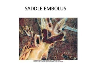 31 Pulmonary embolism and infarction..pptx