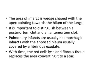 31 Pulmonary embolism and infarction..pptx