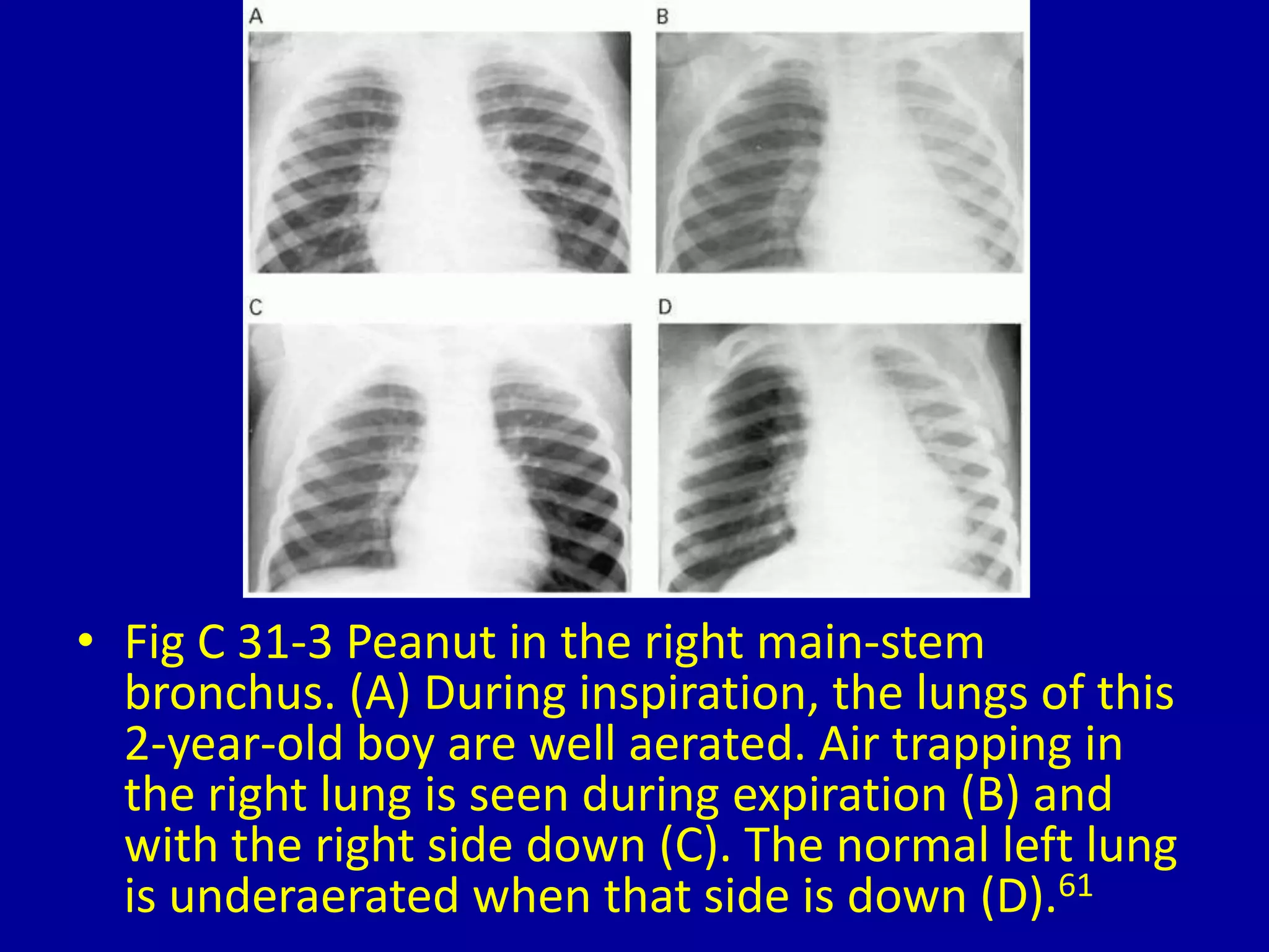 31 shift of the mediastinum | PPTX