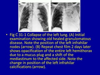 31 shift of the mediastinum | PPTX