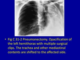 31 shift of the mediastinum | PPTX