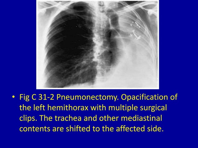 31 shift of the mediastinum | PPT